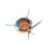 MST Capsule Retractors, Chang Modification – MicroSurgical Technology