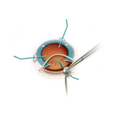 MST Capsule Retractors – MicroSurgical Technology