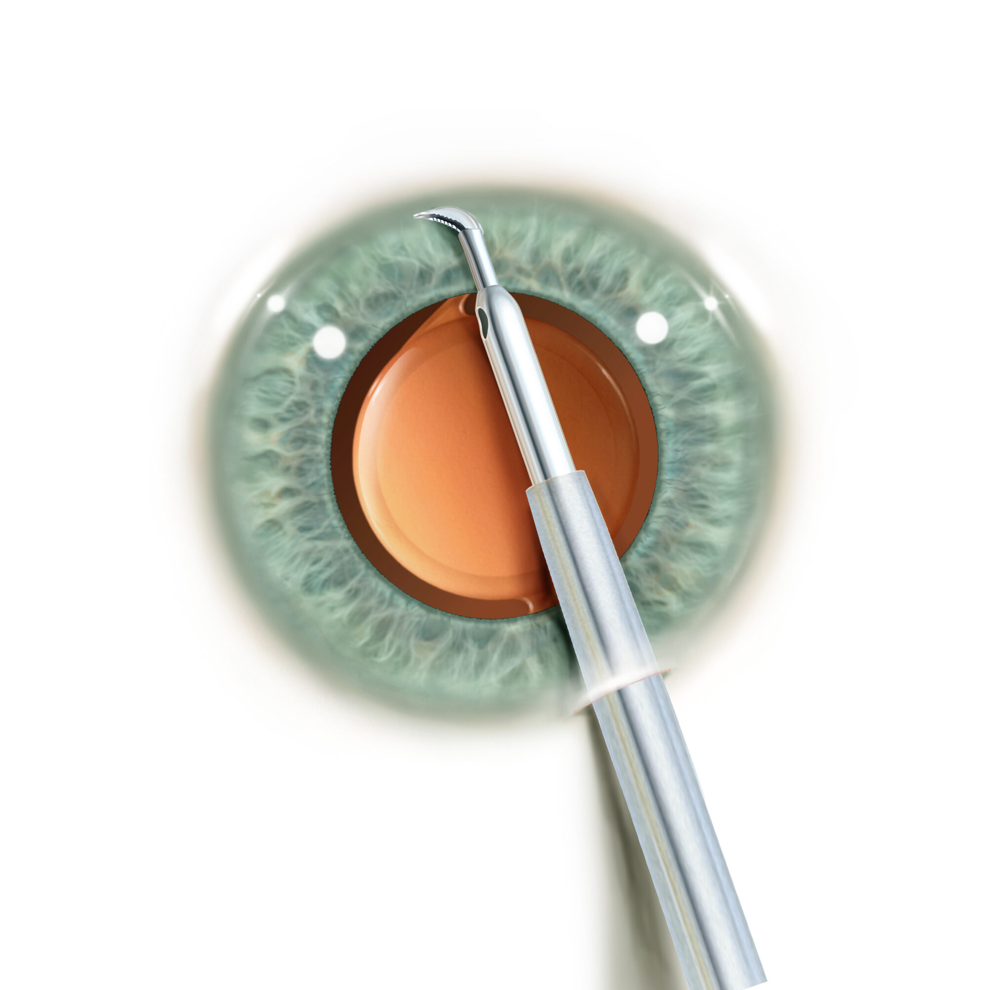 TrabEx Pro – MicroSurgical Technology